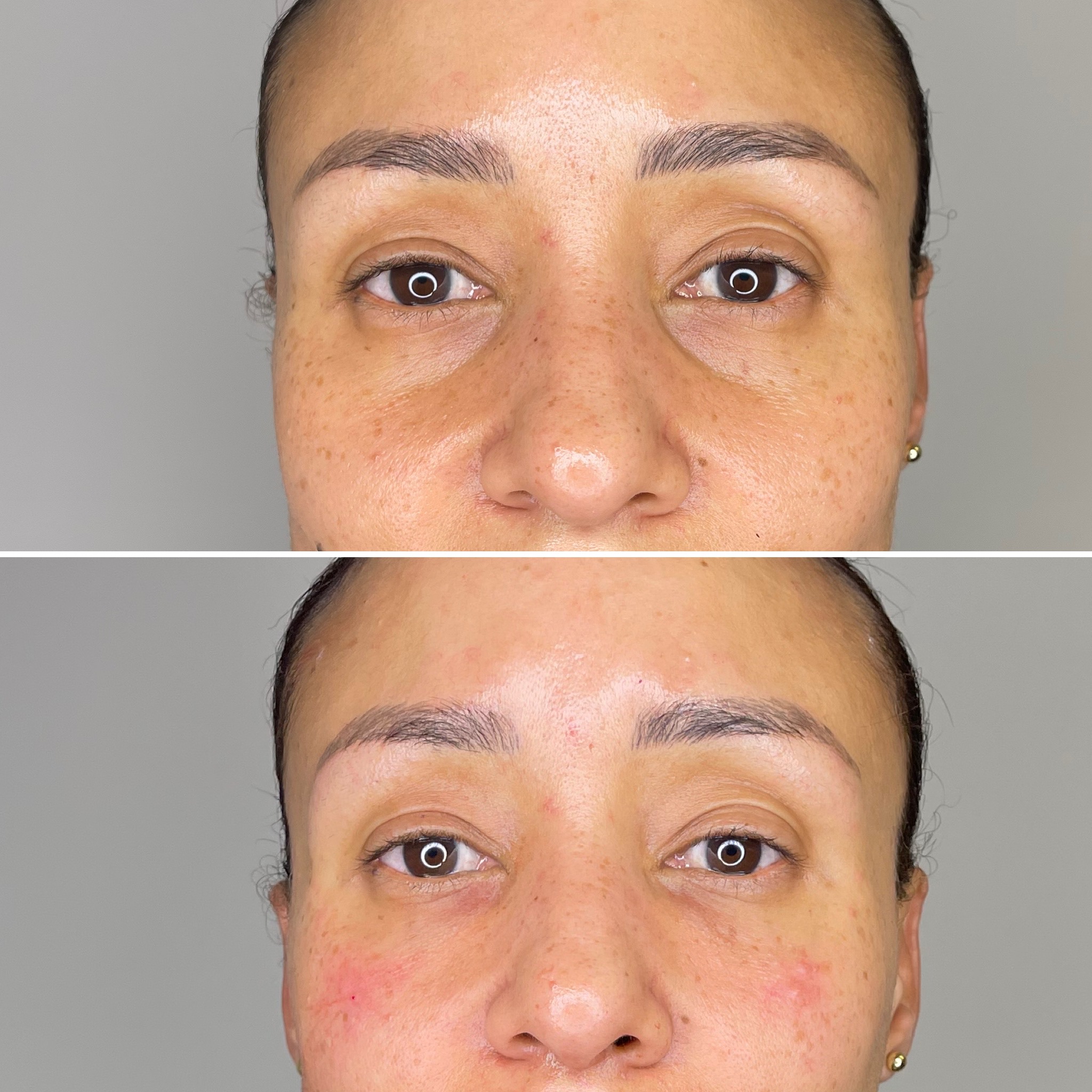 Dermal Filler Tear Trough | Best Hollow and Under Eyes Filler Clinic